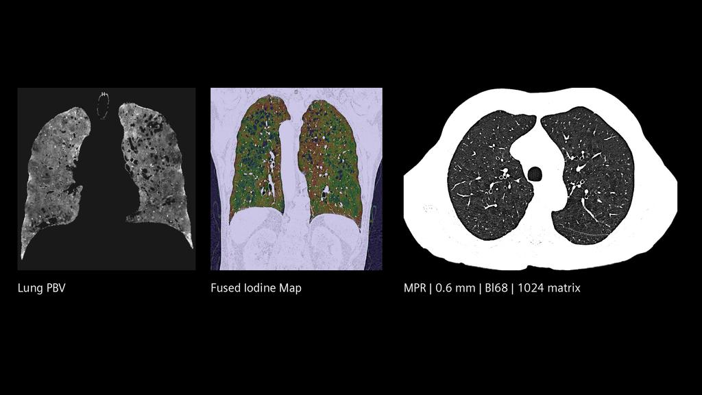 PCCT pulmonology imaging - Siemens Healthineers