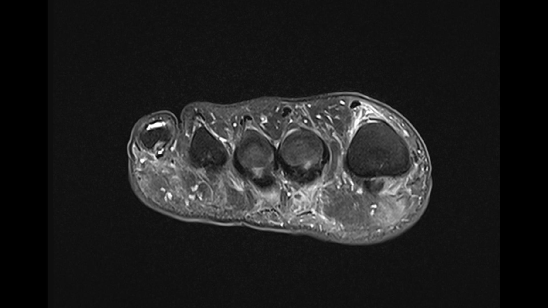 How I do it: Imaging Morton’s Neuroma