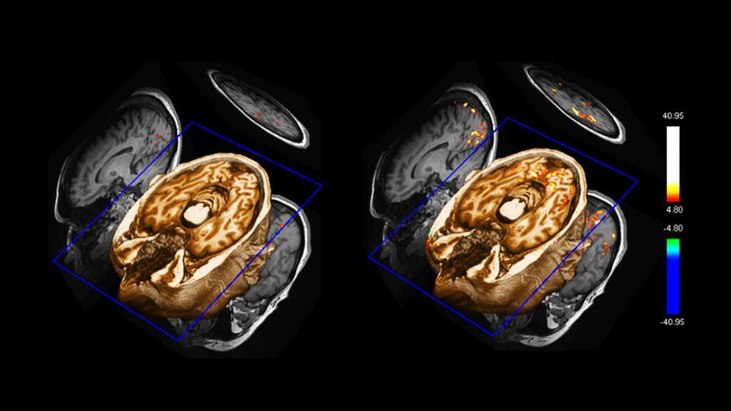 MAGNETOM Prisma - MRI Scanner - Siemens Healthineers
