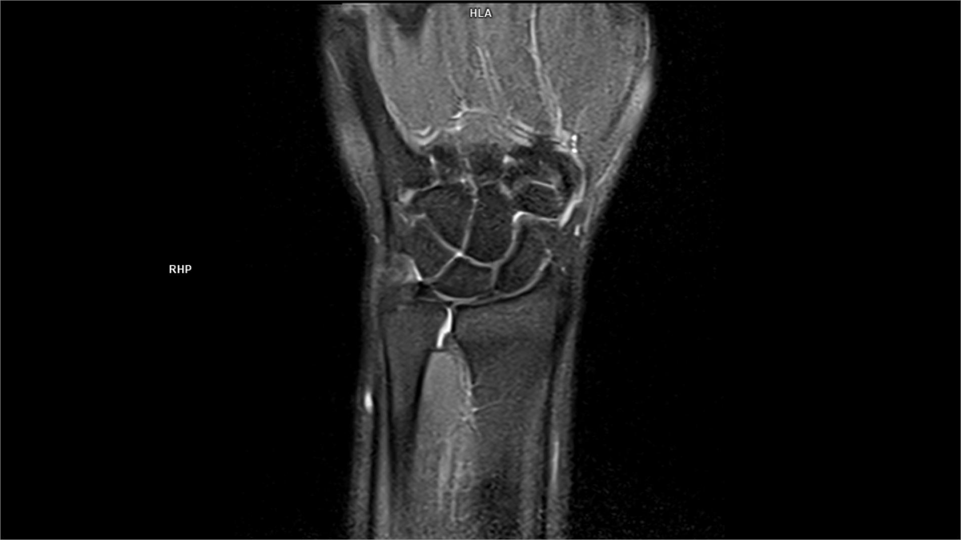 Coronal PD FS-MAGNETOM Free.Max - Siemens Healthineers USA