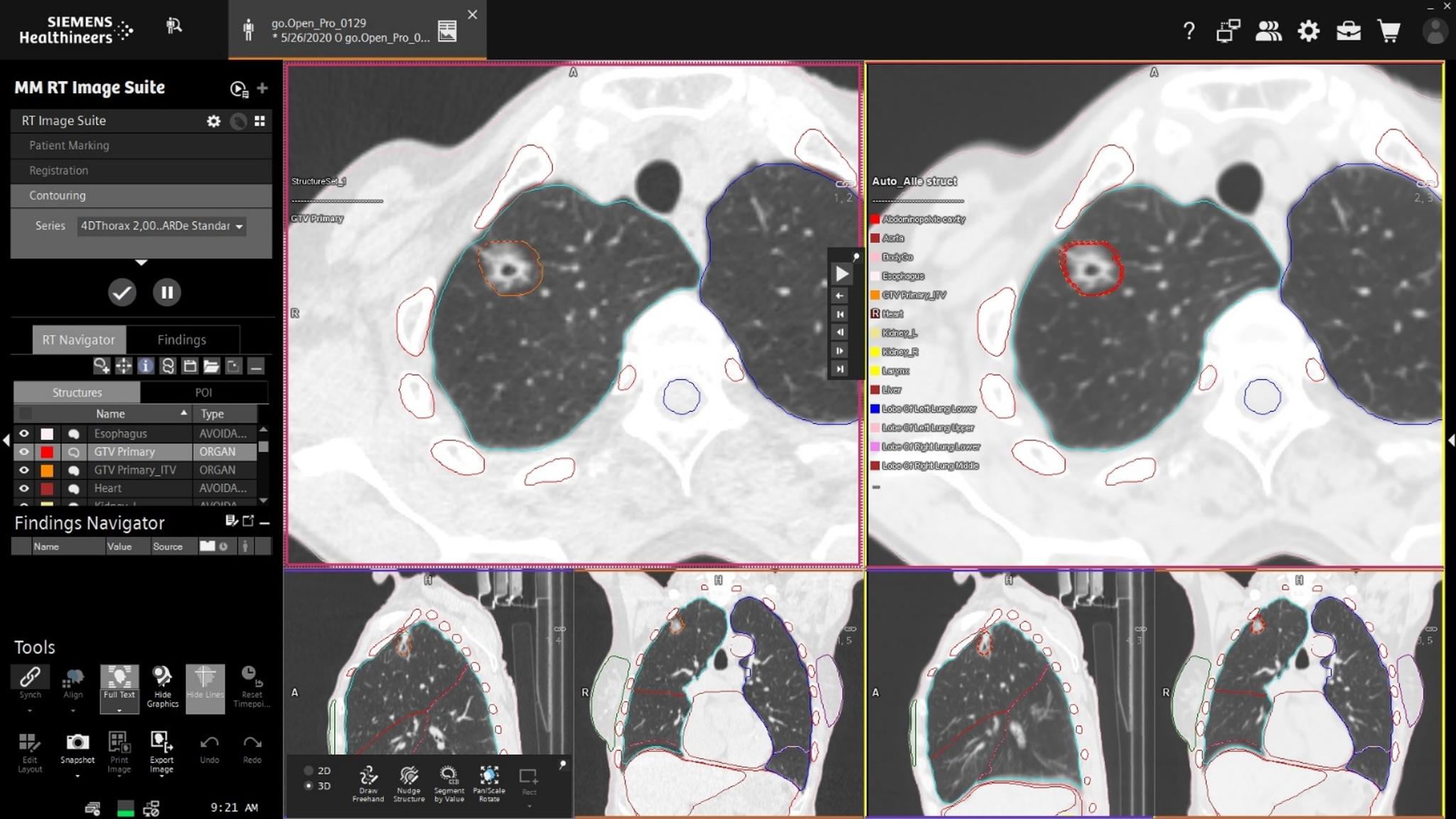 Autocontouring in radiation therapy - Siemens Healthineers - Siemens ...