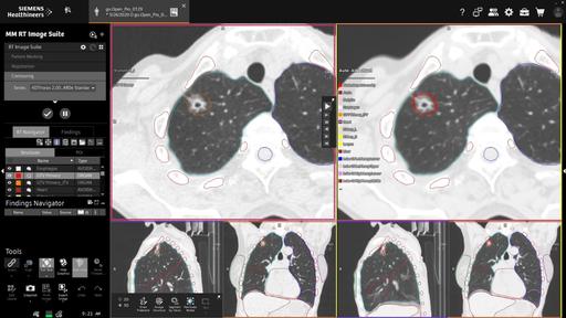 Autocontouring in Radiation Therapy - Siemens Healthineers - Siemens ...