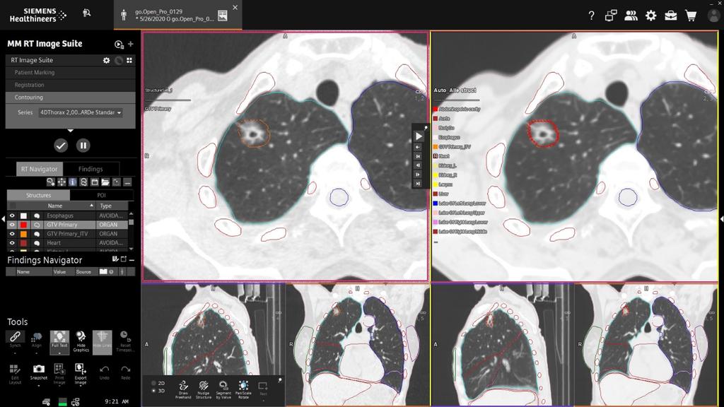 Autocontouring in radiation therapy - Siemens Healthineers - Siemens ...