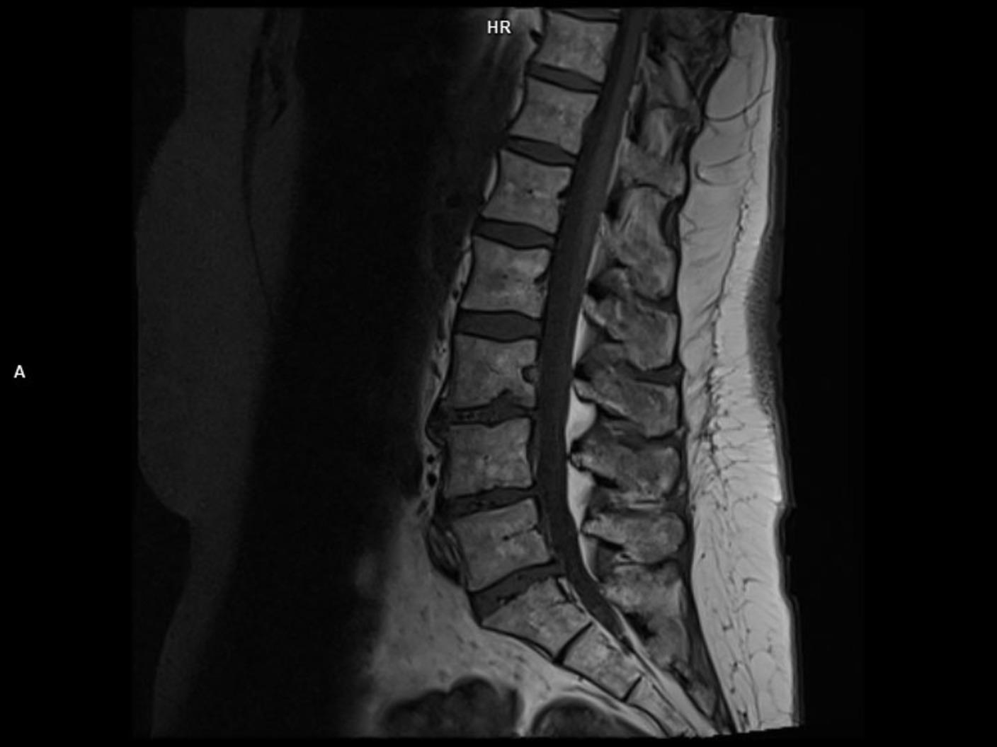 Sagittal T1 TSE-MAGNETOM Lumina - Siemens Healthineers USA