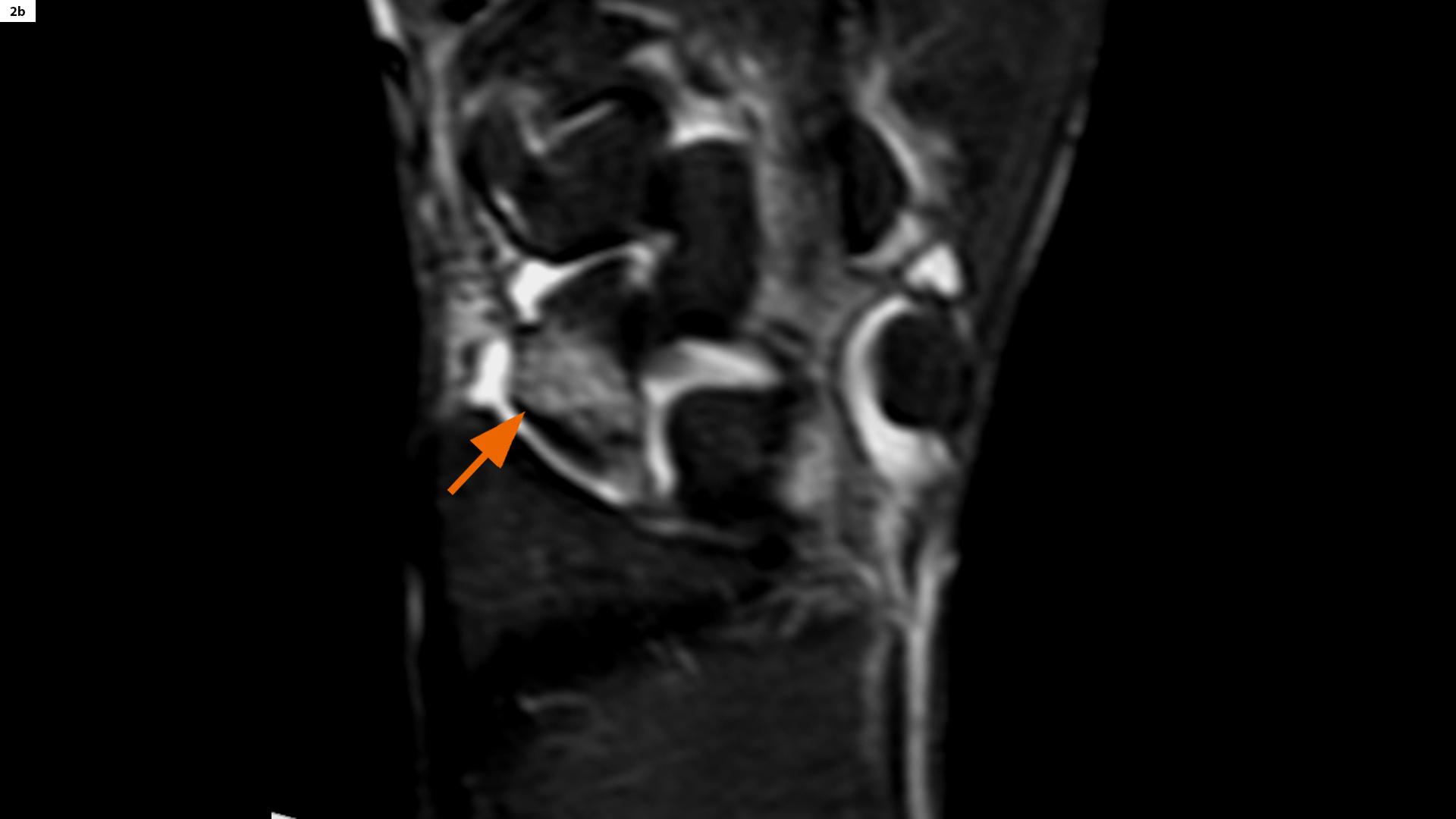 Scaphoid fracture associated bone marrow edema Siemens Healthineers ...