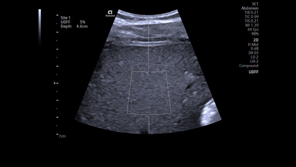 ACUSON Redwood Ultrasound System - Siemens Healthineers