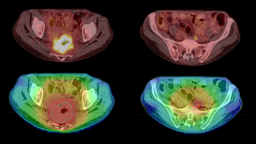 Biograph PET/CT family for radiation therapy planning - Siemens ...