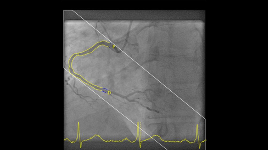 Rethink FFR assessment for every patient