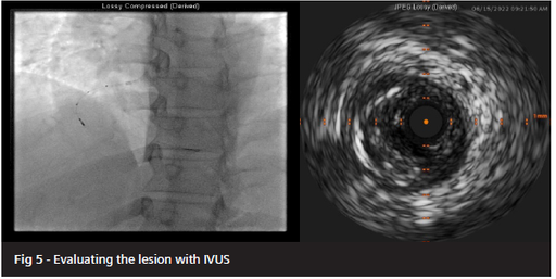 IVUS PCI for Acute Inferior ST Elevation MI of Occluded RCA Corindus ...