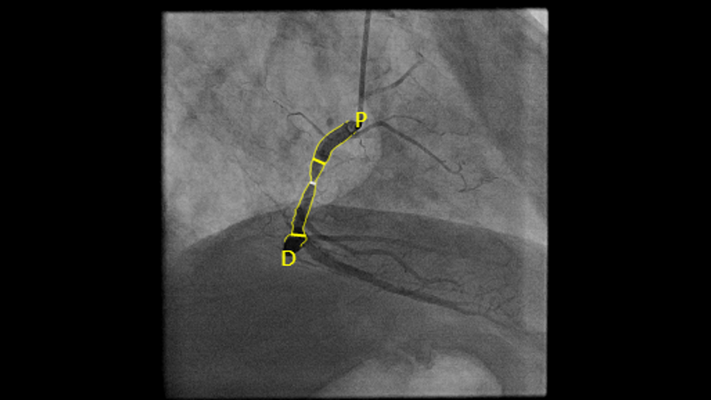 vFFR - angio-derived FFR measurements - Siemens Healthineers - Siemens ...
