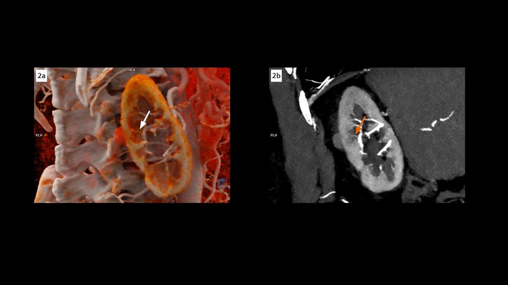 Inside an incidental solid renal mass - Siemens Healthineers