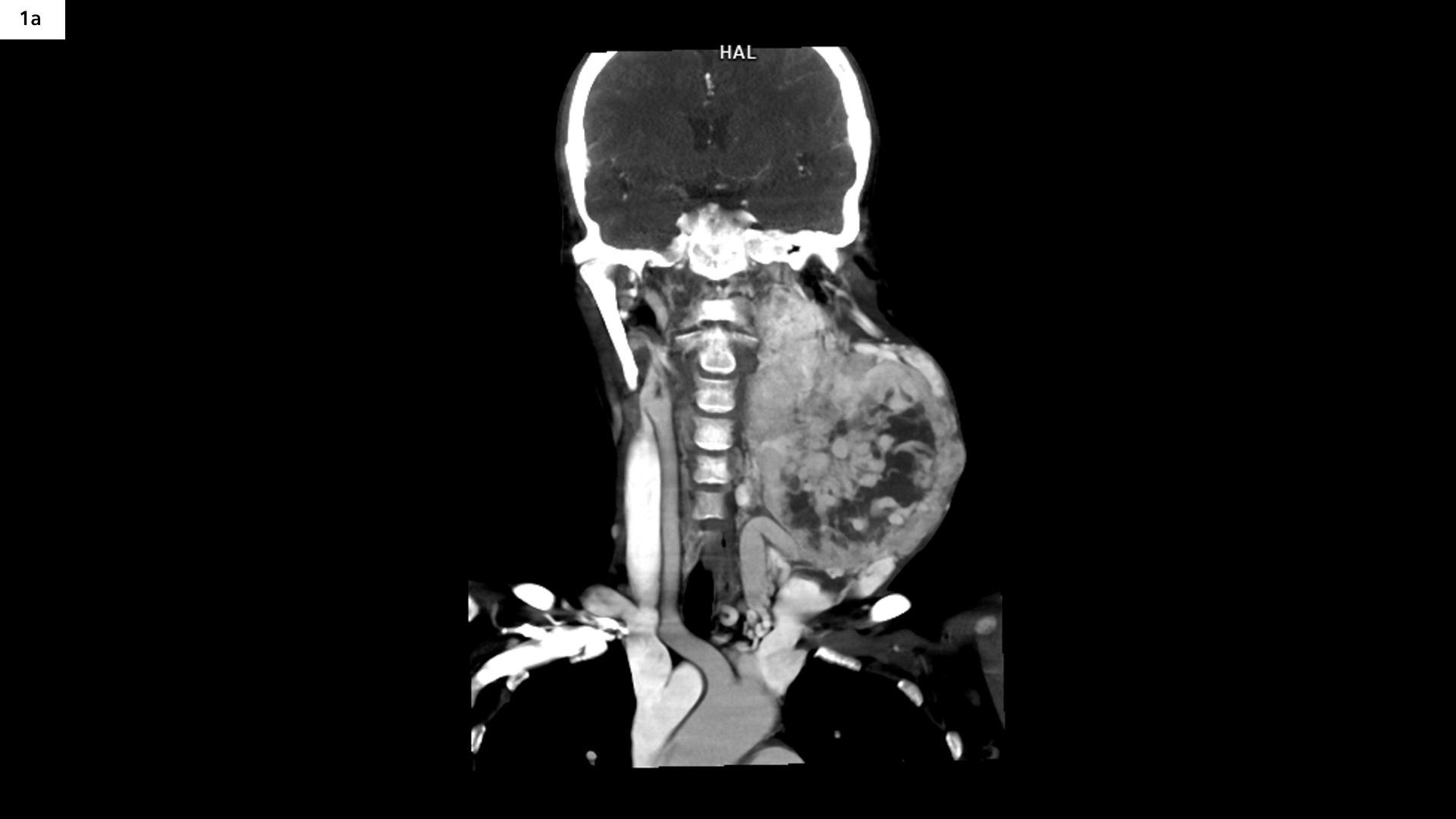 Massive carotid body tumor