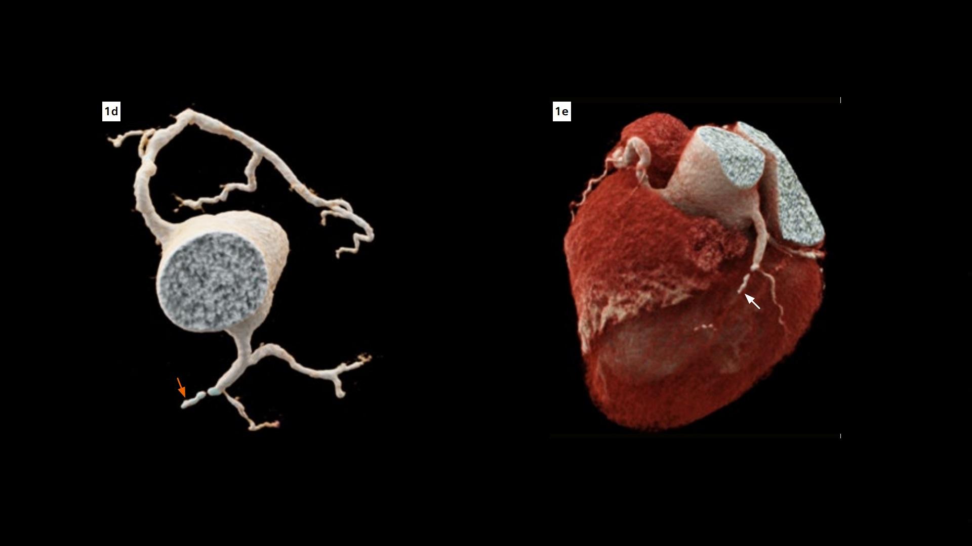 LAD occlusion – acute or chronic? - Siemens Healthineers Portugal