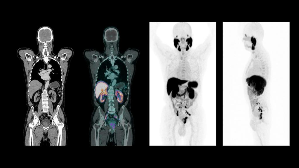 A comparative analysis of 99mTc-iPSMA SPECT/CT and 18F-PSMA-1007 PET/CT - Siemens Healthineers ...