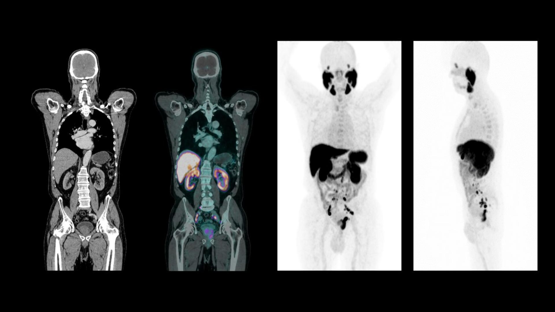 A comparative analysis of 99mTc-iPSMA SPECT/CT and 18F-PSMA-1007 PET/CT - Siemens Healthineers