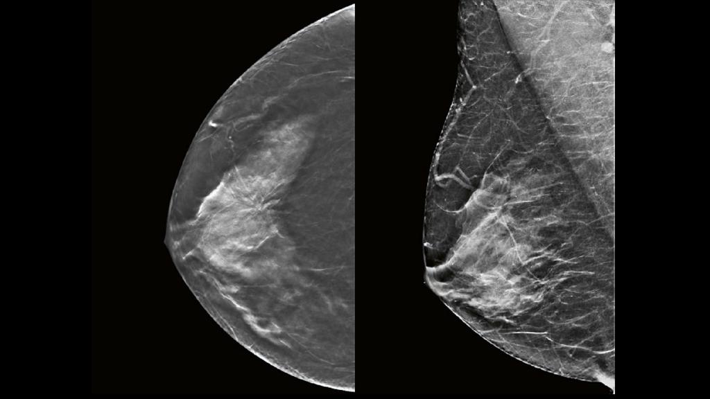 Casos prácticos de ultrasonido de mama - Siemens Healthineers Latinoamérica