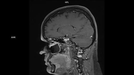 T1 SPACE SPAIR FS SAG post-MAGNETOM Sola - Siemens Healthineers USA