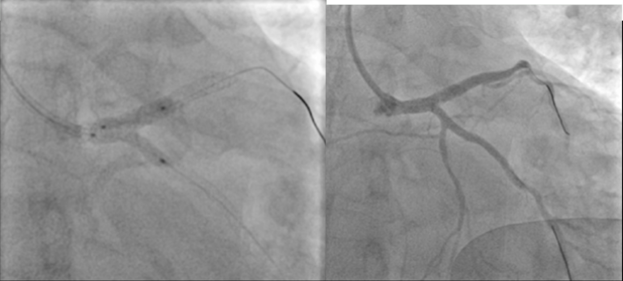Enhanced stent visualization assists in improving the outcome of ...