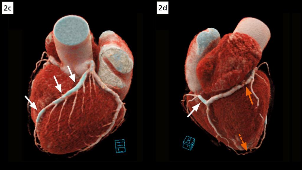 Triple-vessel coronary disease with multiple stents - Siemens Healthineers