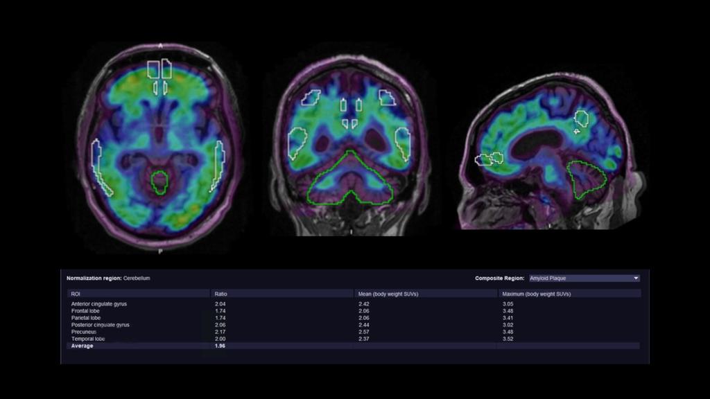 Beta-amyloid PET/CT imaging in the assessment of memory loss and dementia - Siemens Healthineers USA