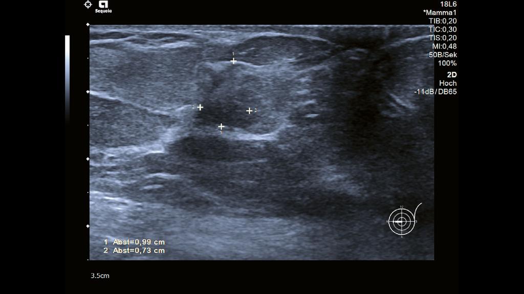 Casos prácticos de ultrasonido de mama - Siemens Healthineers Latinoamérica
