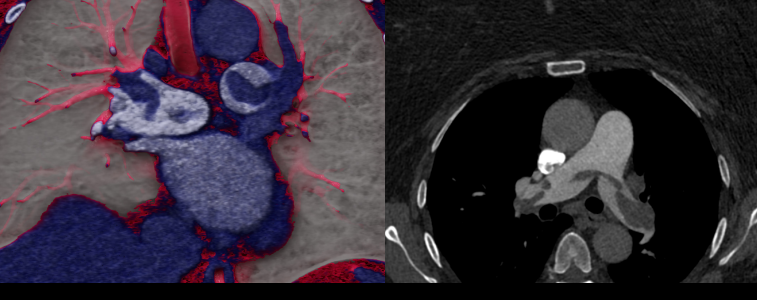 The spectrum of Cardiothoracic CT imaging – Case discussion with dual ...