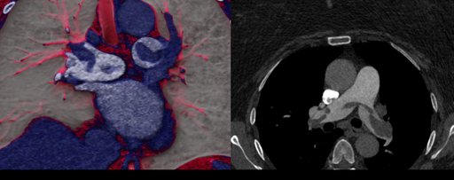 The spectrum of Cardiothoracic CT imaging – Case discussion with dual ...