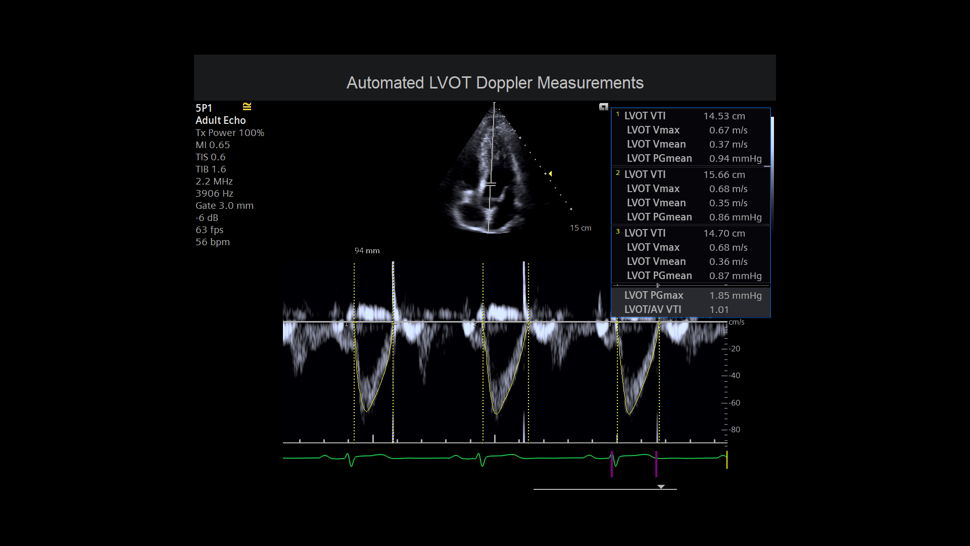 ACUSON Juniper, CV Edition Ultrasound System - Siemens Healthineers