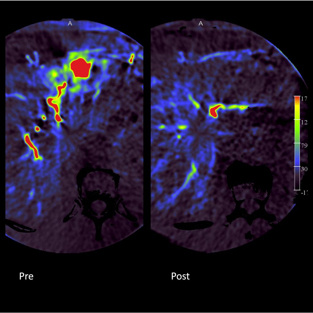 Interventional Oncology Procedures - Siemens Healthineers