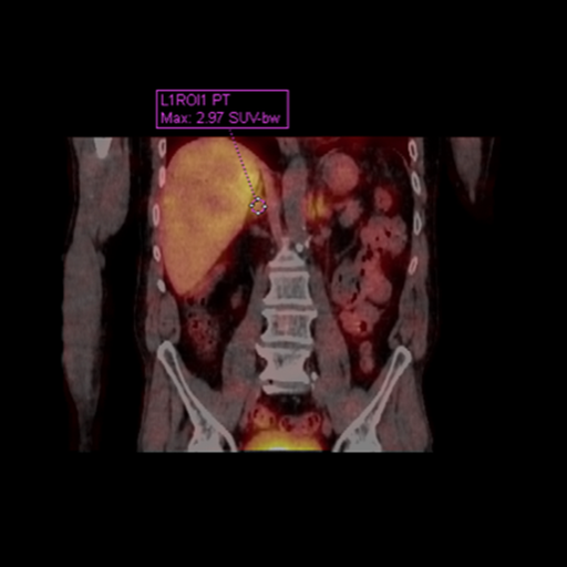 Symbia Intevo Bold eco - Siemens Healthineers
