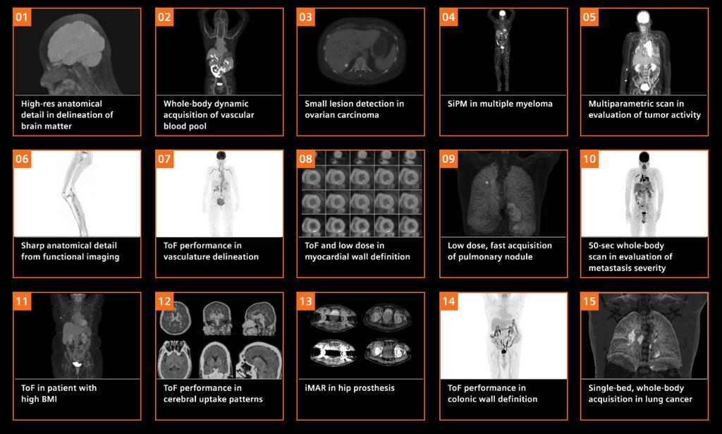 Biograph Vision PET/CT Clinical Image Gallery - Siemens Healthineers