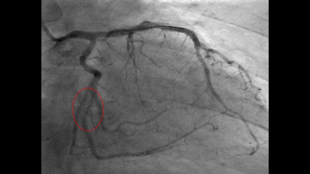 PET/CT delineation of multivessel coronary artery disease and post ...