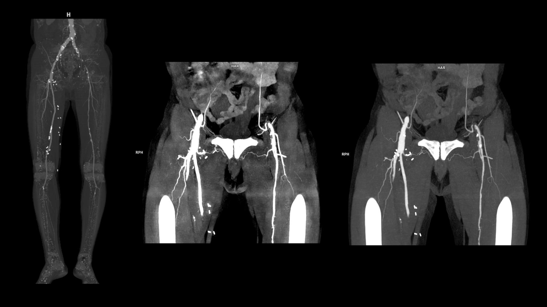 Dual Energy CT Spectral Imaging - Siemens Healthineers USA