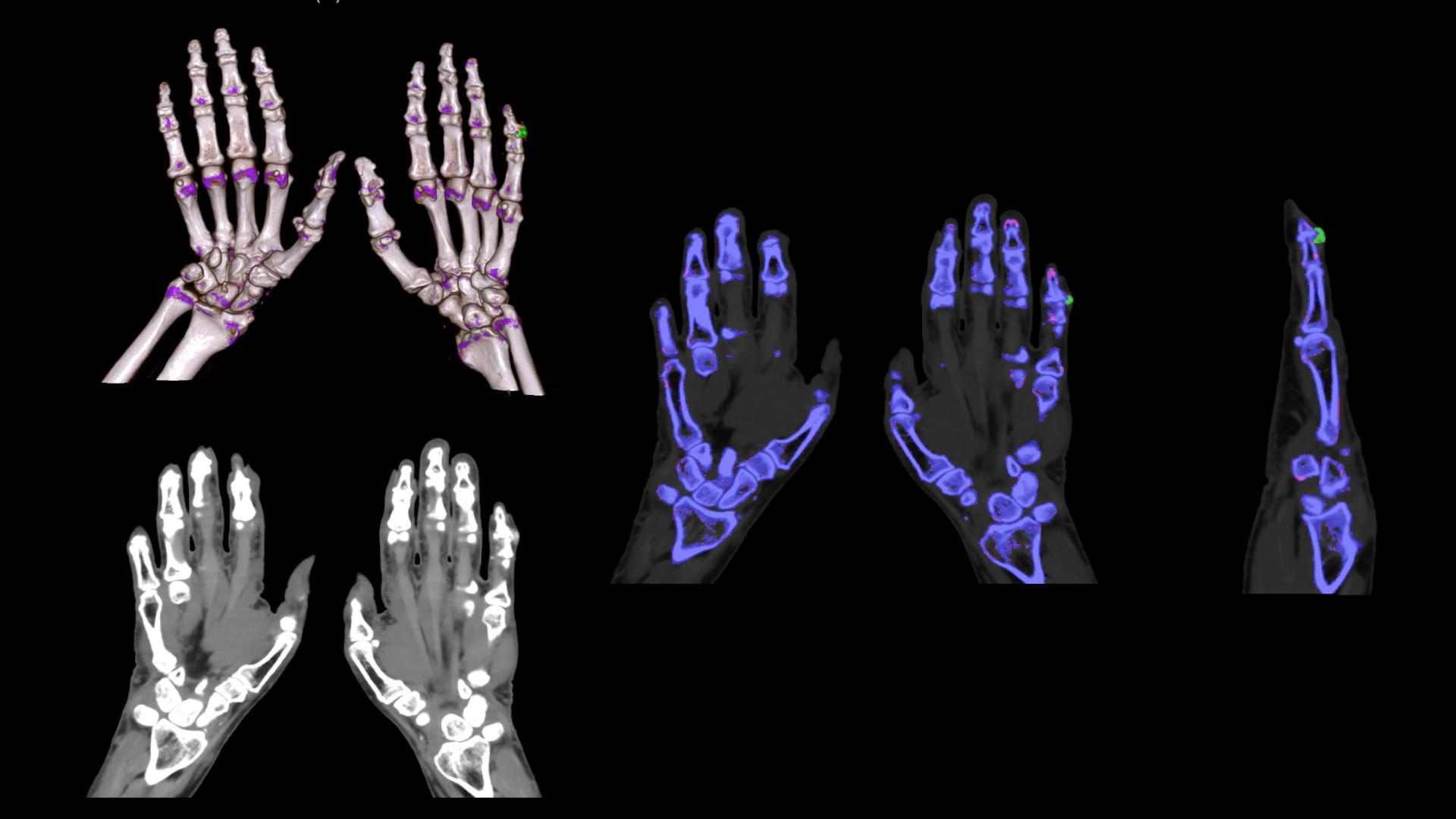Dual Energy CT Spectral Imaging - Siemens Healthineers USA