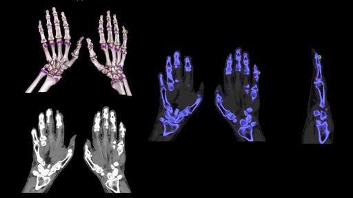 Dual Energy CT Spectral Imaging - Siemens Healthineers USA