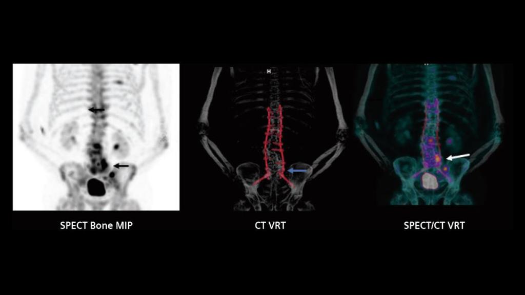 SPECT/CT imaging in the evaluation of pain following spinal fusion ...