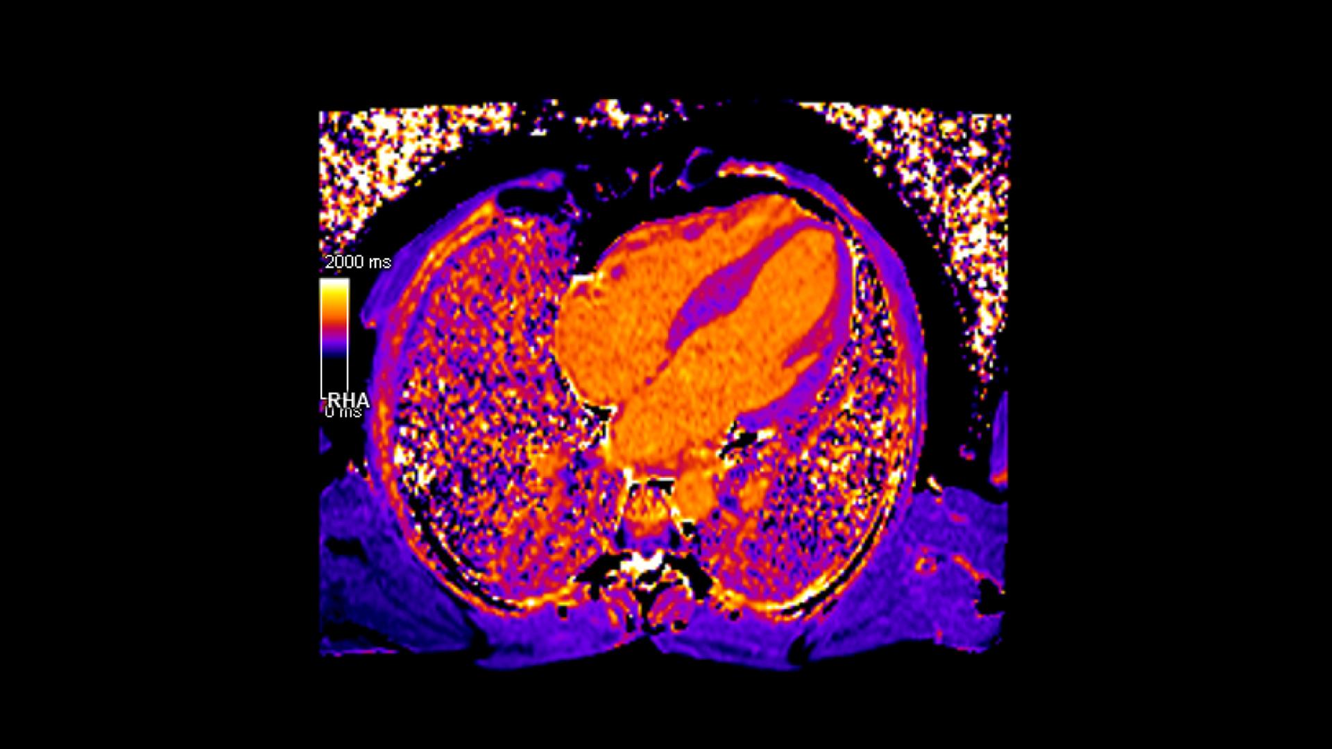 Cardiovascular MRI - Siemens Healthineers
