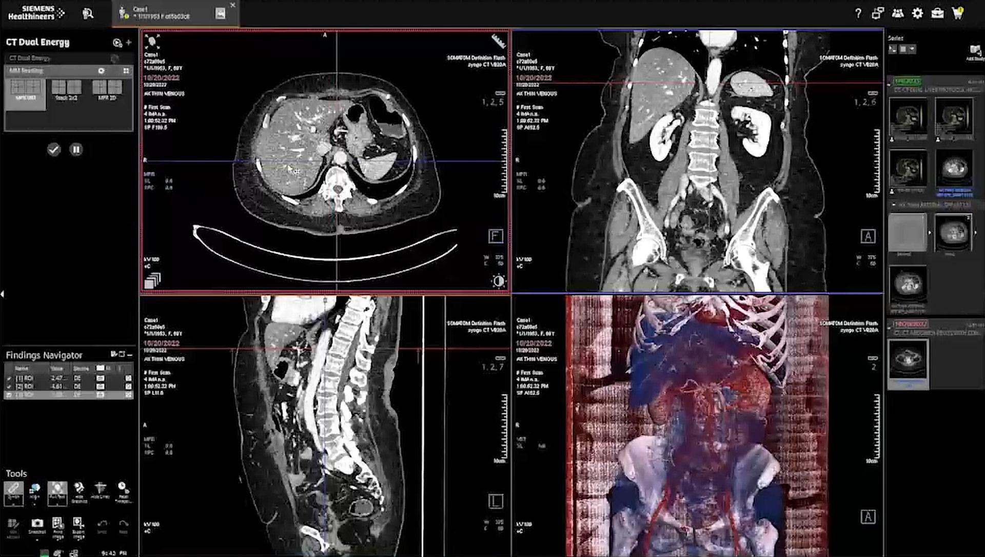 Real world results: Impact of photon-counting CT in the assessment of ...