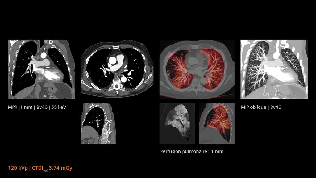 NAEOTOM Alpha - Applications pulmonaires - Siemens Healthineers France