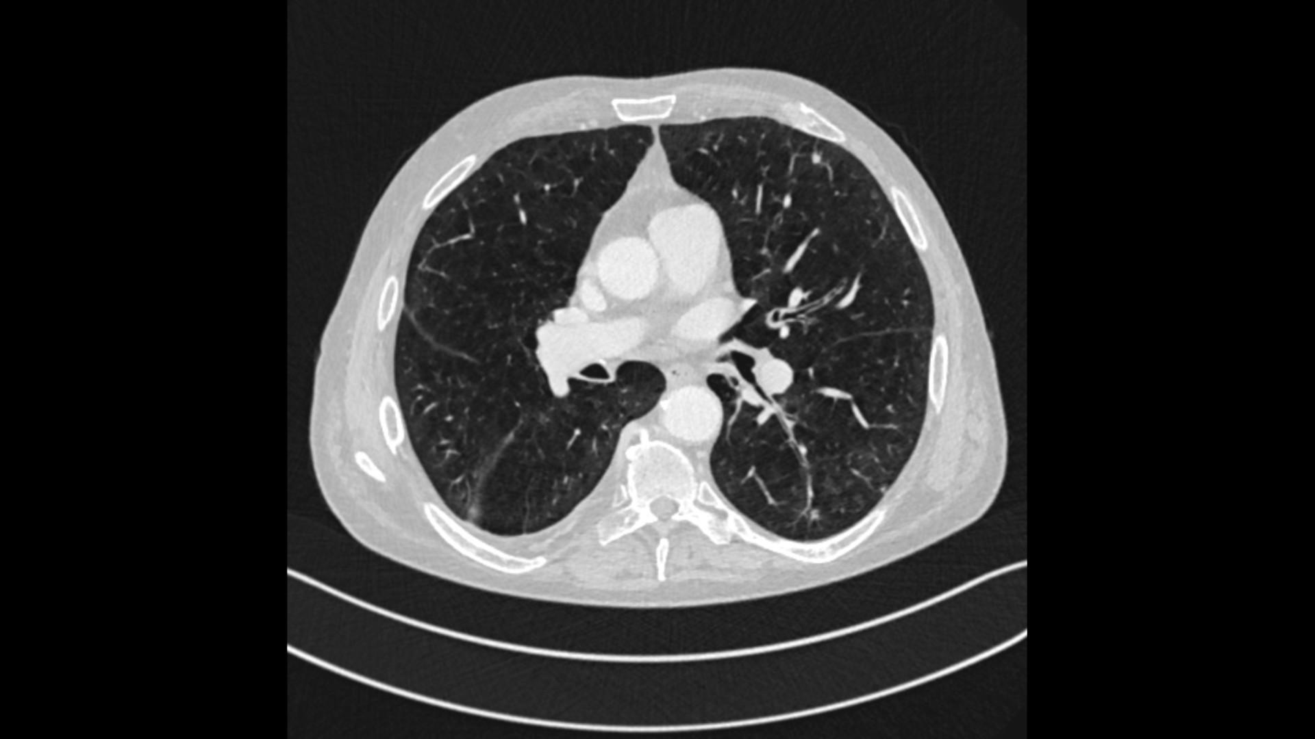 AI-Rad Companion - Siemens Healthineers