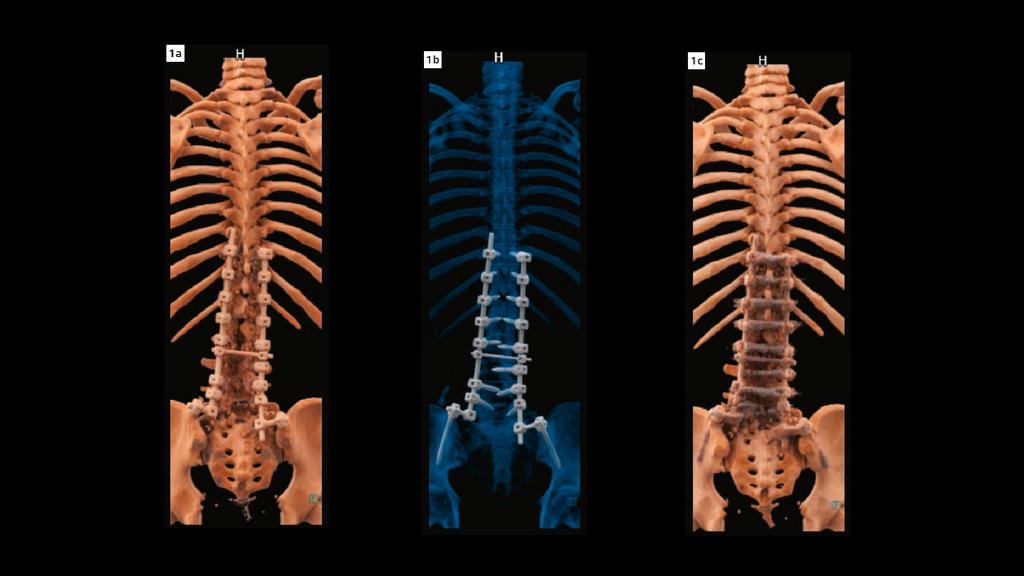 Osteosíntesis espinal complicada por osteólisis postoperatoria y ...