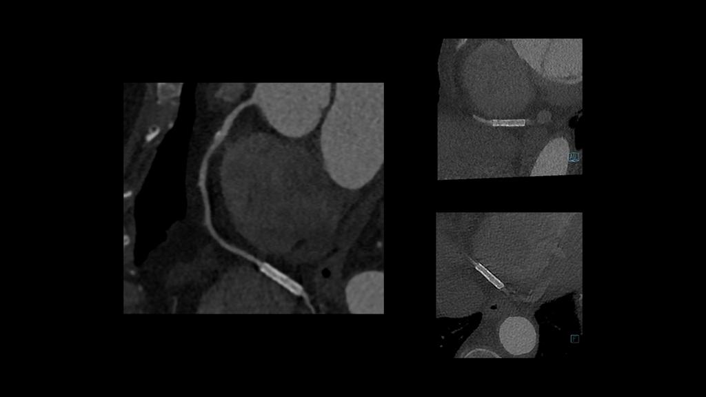 SOMATOM Definition Edge - Siemens Healthineers India