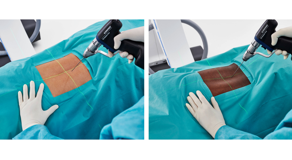 Mobile C-arm Machine - Cios Select with FD - Siemens Healthineers USA