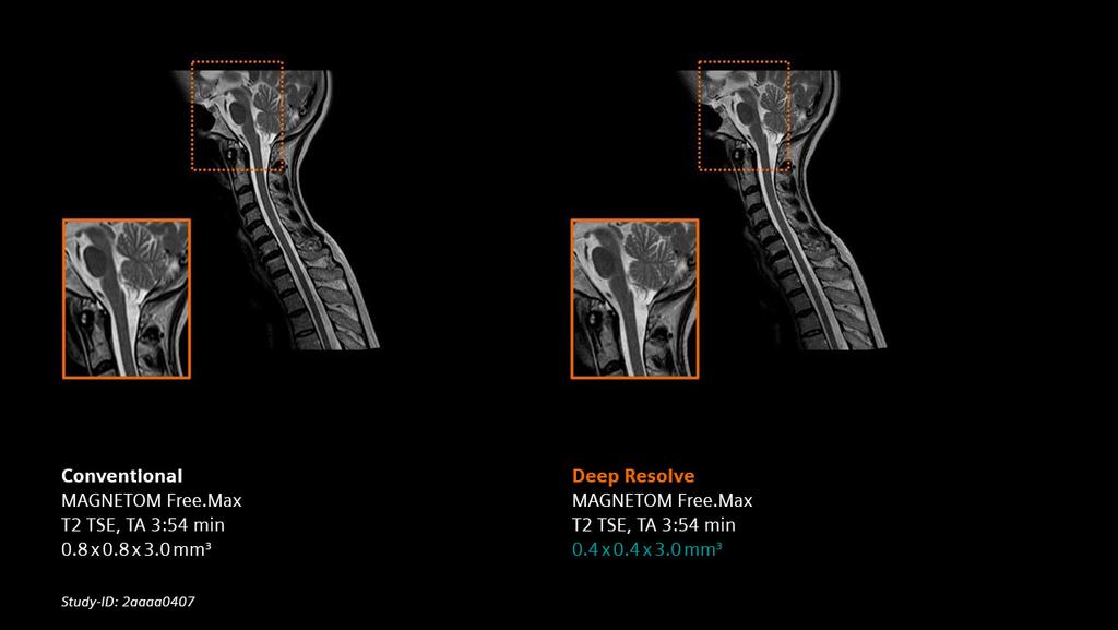 Deep Resolve - Siemens Healthineers