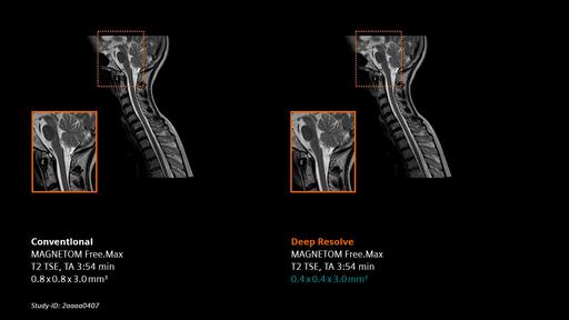 Deep Resolve - Siemens Healthineers
