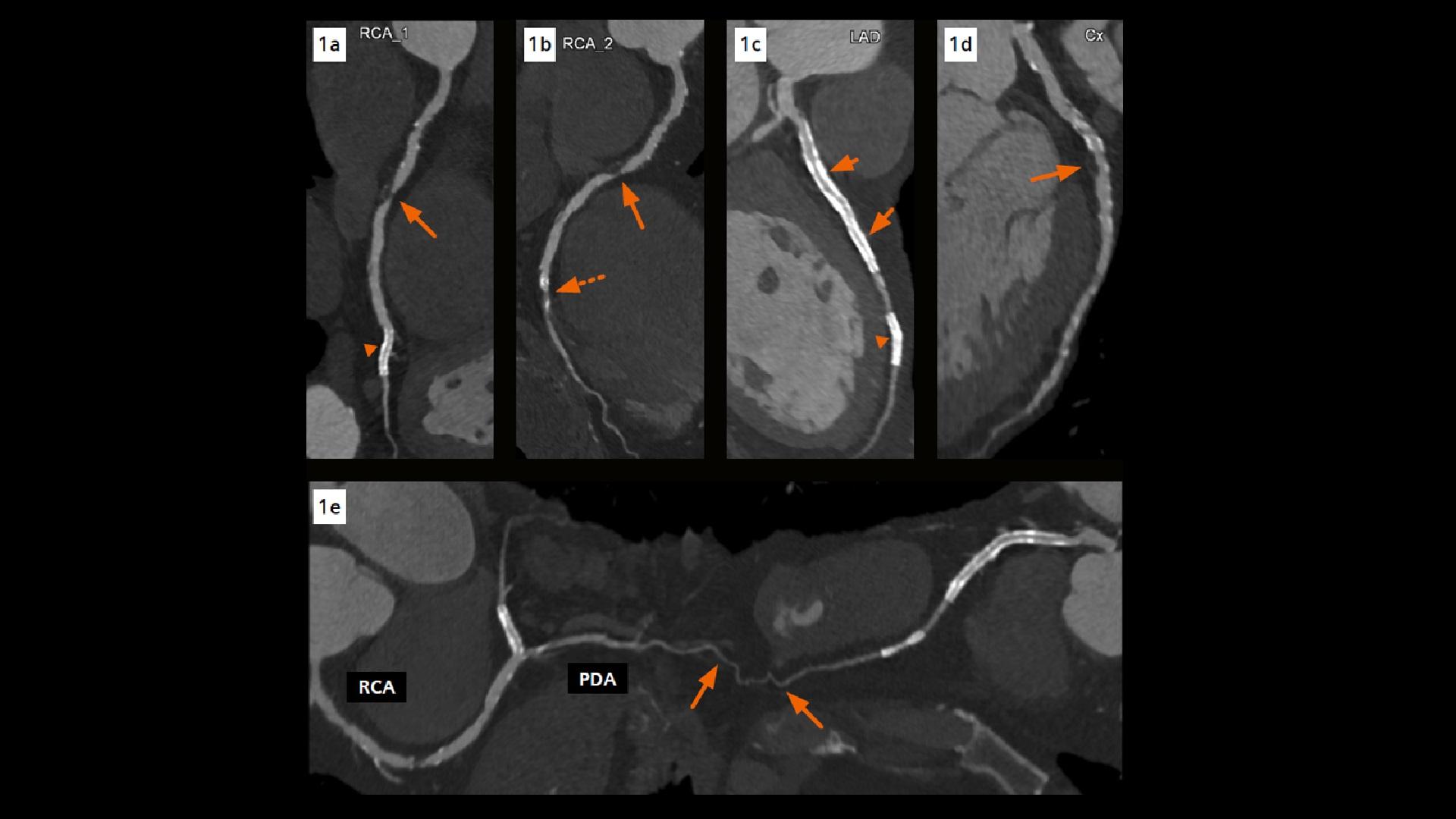 Triple-vessel coronary disease with multiple stents - Siemens Healthineers