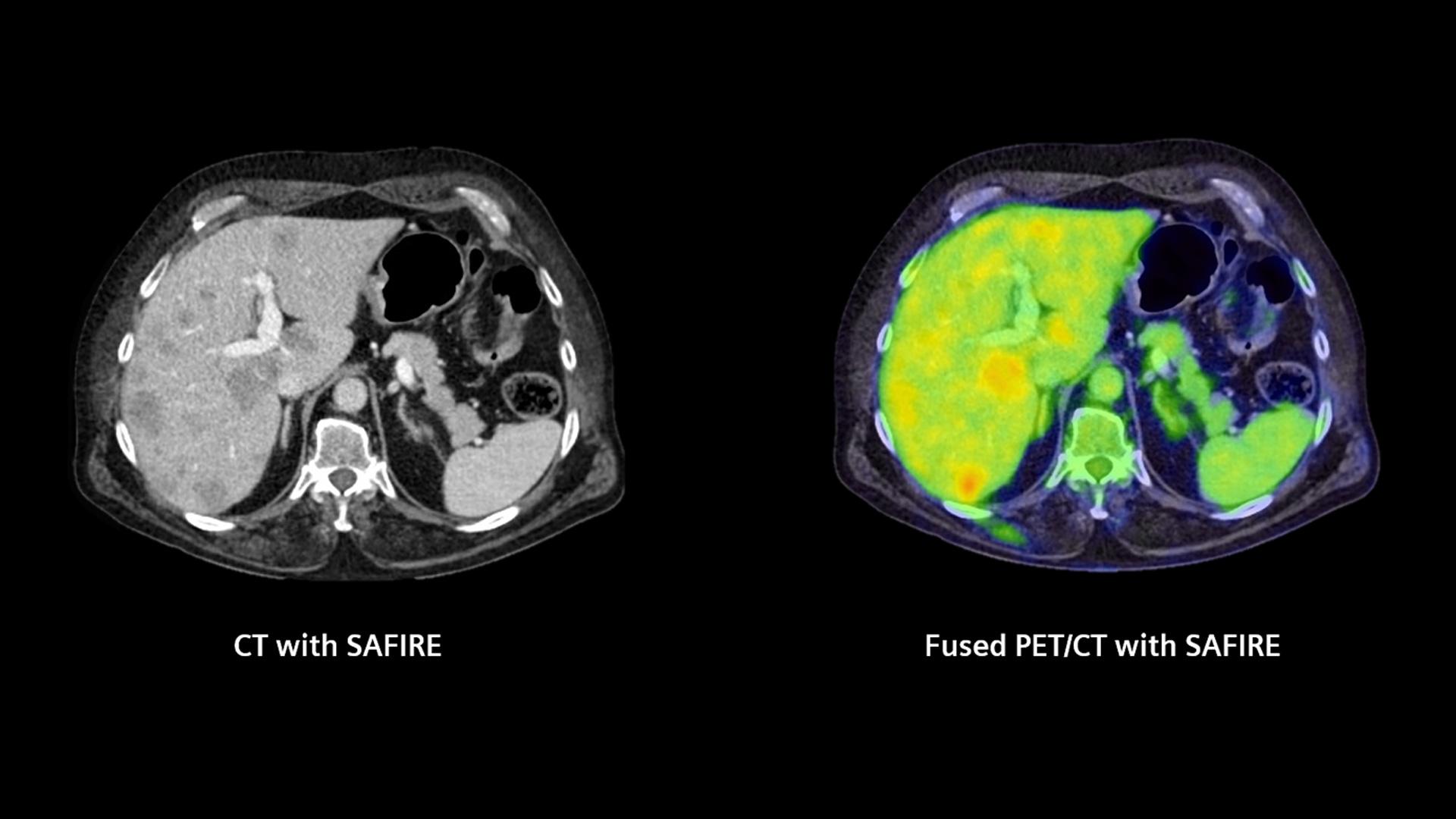SAFIRE - Sinogram Affirmed Iterative Reconstruction - Siemens Healthineers