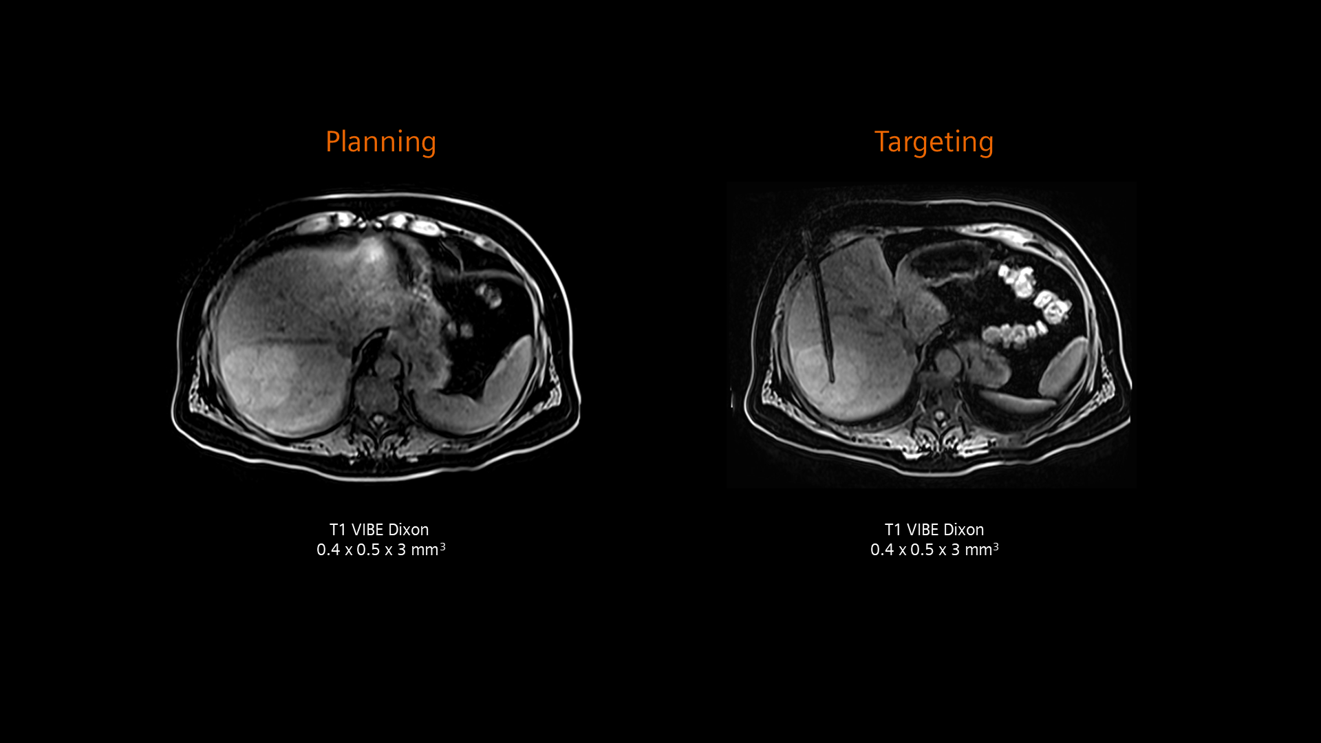 Interventional MRI Suite – Leading the way in iMRI - Siemens Healthineers