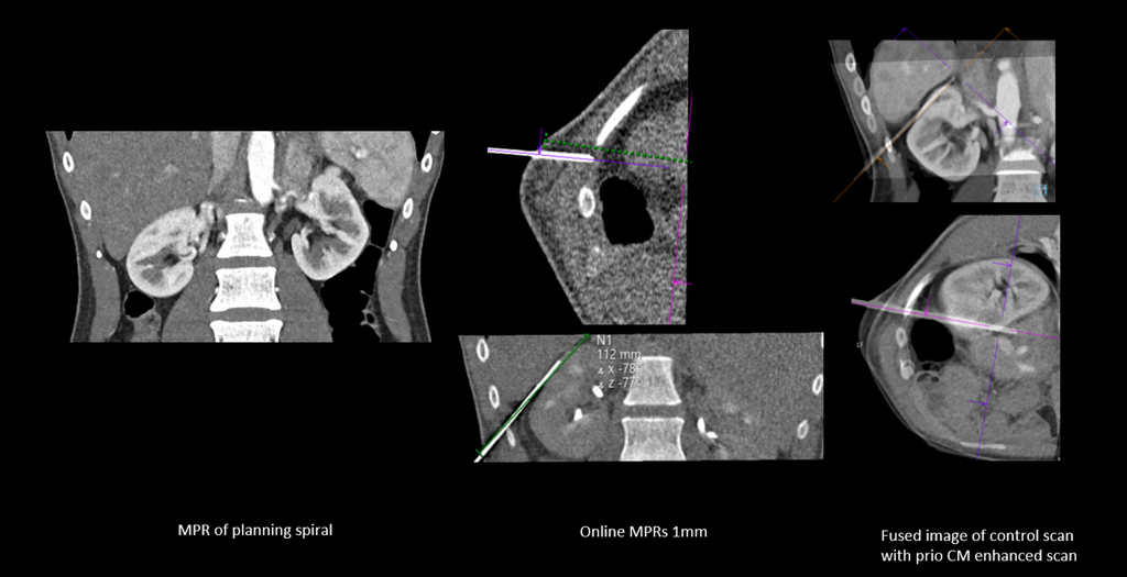 CT-guided interventions - Siemens Healthineers