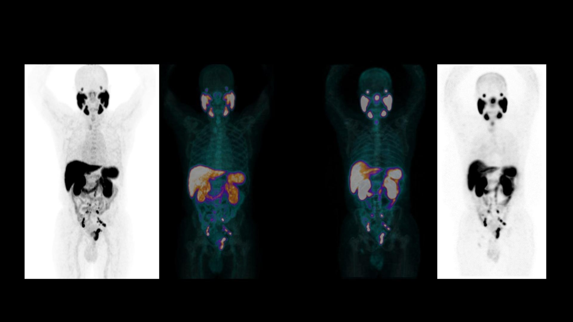 A comparative analysis of 99mTc-iPSMA SPECT/CT and 18F-PSMA-1007 PET/CT - Siemens Healthineers ...